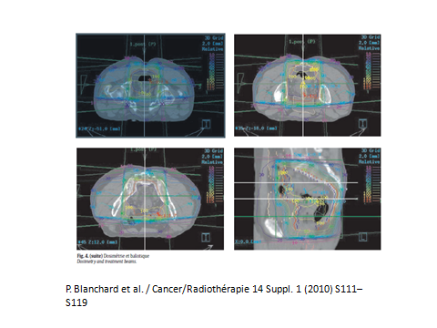 Cancer Colorectal CCR